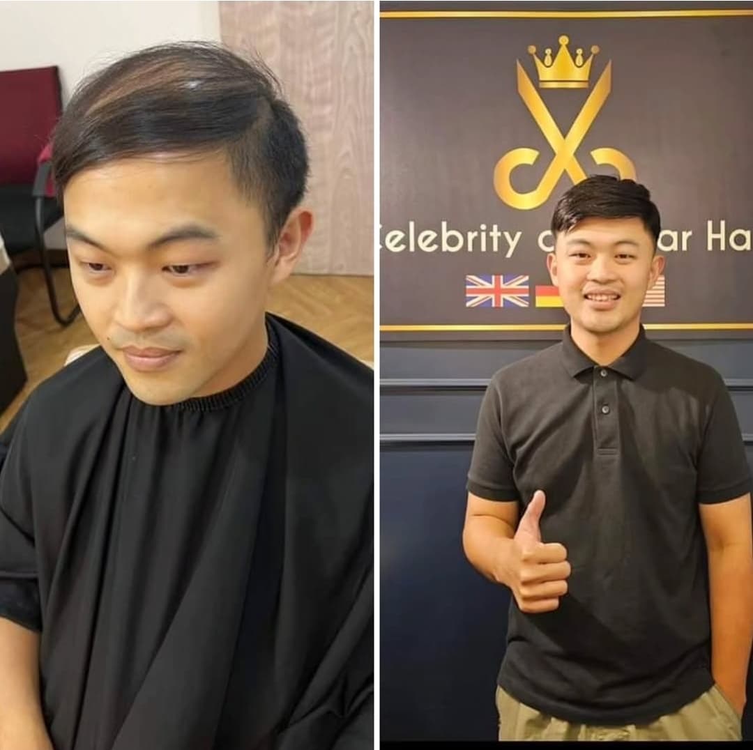 Why Hair Transplants Are on the Rise Among Malaysian Men | Celebrity ...